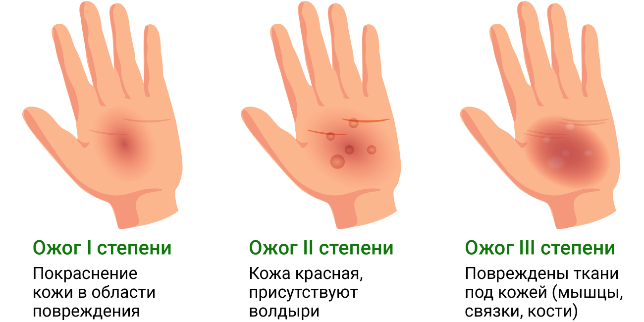 Мази и кремы от ожогов: антисептические, заживляющие, от рубцов